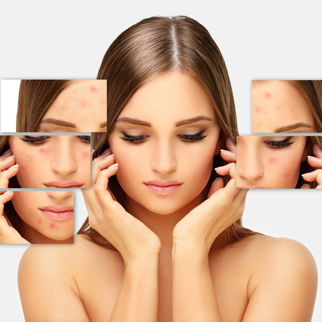 Curing Acne from the Inside Out - Waverly DermSpa